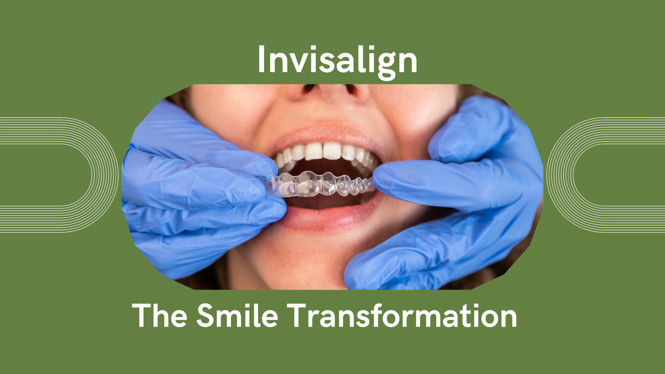 Invisalign: The Smile Transformation