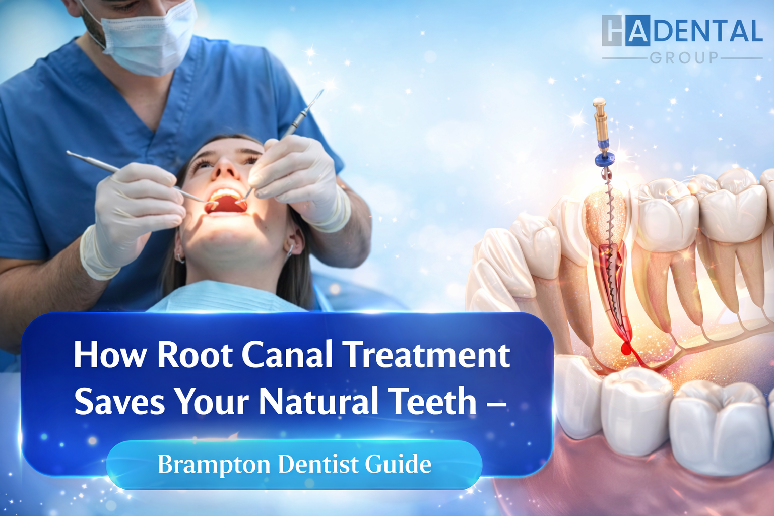 Root Canal Brampton: How Root Canal Treatment Saves Your Natural Teeth ...